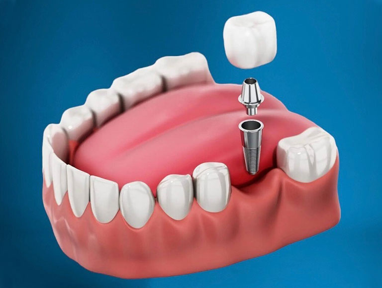 Tooth Replacement Options in Tampa, FL | 24 Hour Smiles